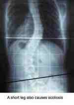 Superficial tingling numbness and coldness in lower legs