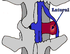 Lateral disc herniation creates something of a dilemma for the chiropractor