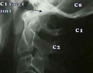 Atlanto occipital joint is a common cause of headaches.