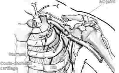 Tietzes syndrome causes pain and tenderness over the sternum and ribs.
