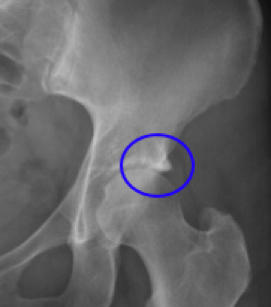 Femoro acetabular impingement syndrome pincer is a stiff hip in the ...