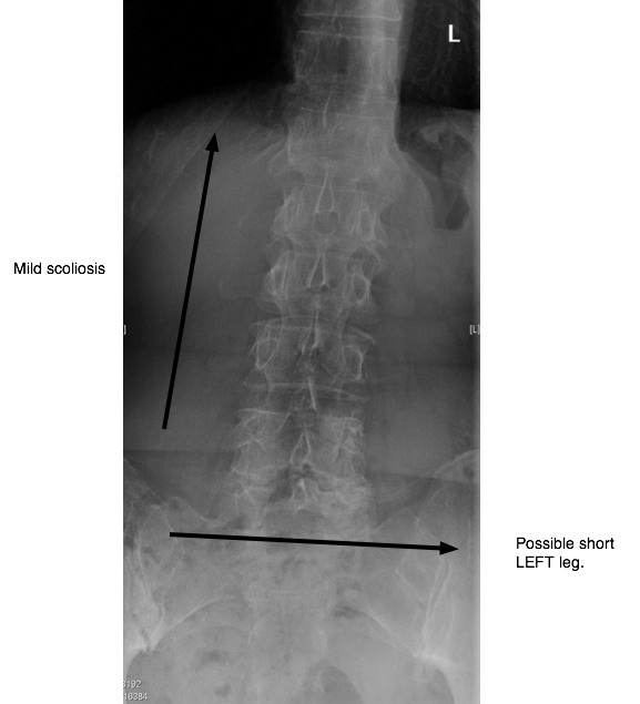 Lumbar Facet Arthropathy Spondylolysthesis with lower back & leg pain.