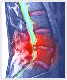 Slipped disk is the cause of misery to millions with radiating pain.